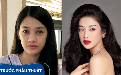 Nàng Kiều Trình Mỹ Duyên công khai hình ảnh phẫu thuật thẩm mỹ