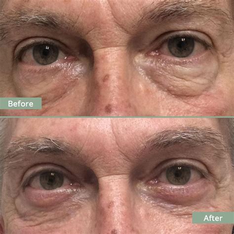 Blepharoplasty Eyes Lids Face Clinic Clare Ireland