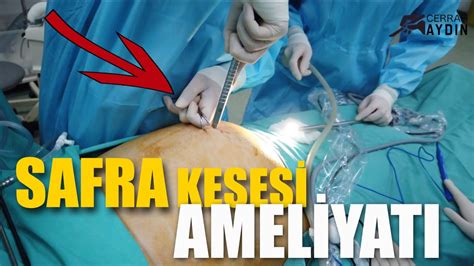 TÜM AŞAMALARIYLA KAPALI SAFRA KESESİ AMELİYATI İZLE LAPAROSCOPIC