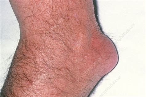 Olecranon Bursitis Student S Elbow Stock Image M