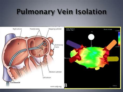 Ppt Atrial Fibrillation Updates Powerpoint Presentation Id