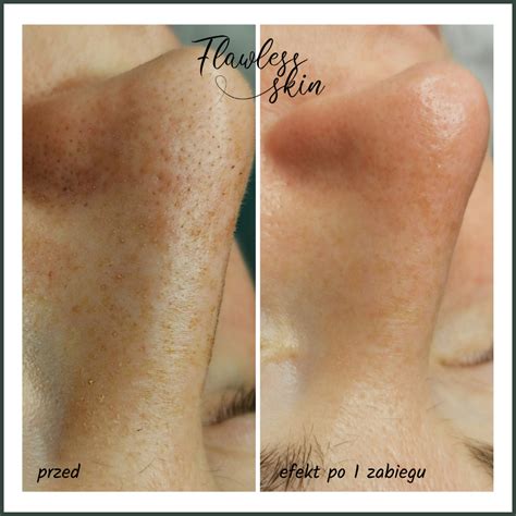 Usuwanie makijażu permanentnego FLAWLESS SKIN