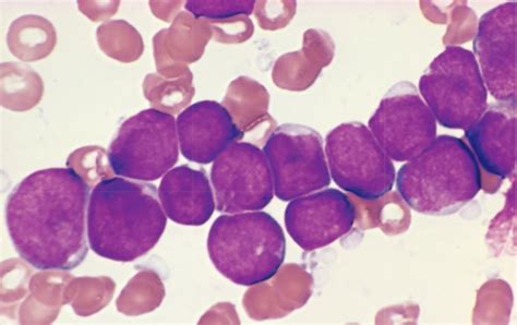 MHD 73 Hematopathology Acute Leukemia Flashcards Quizlet
