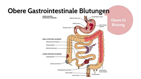 Obere GI Blutung By Vanthu Bui On Prezi