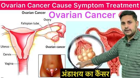 Ovarian Cancer Cause Symptoms Diagnosis Treatment In Hindi What Is