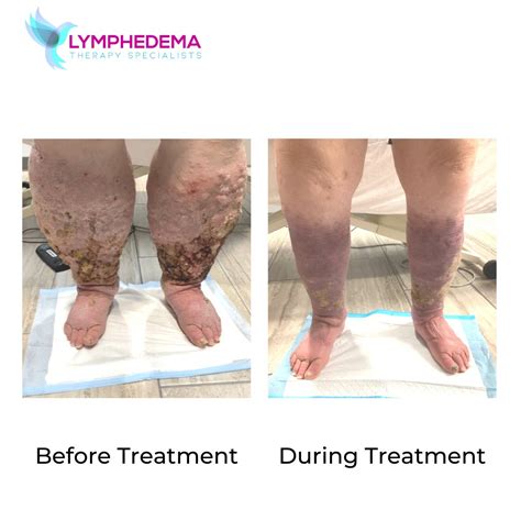 Lymphedema Treatment