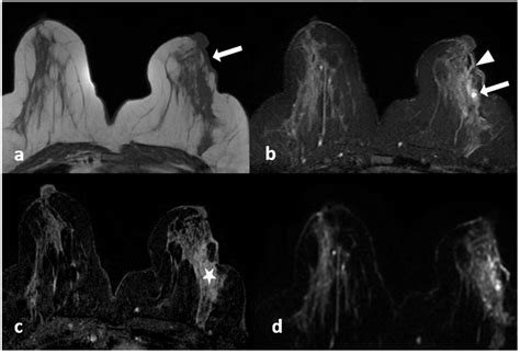 diagnostics free full text idiopathic granulomatous mastitis or breast cancer a comparative