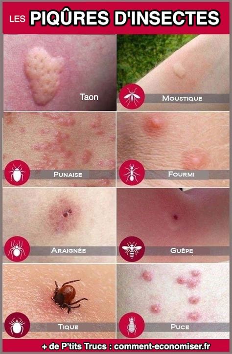 Piqure D Insecte Quel Insecte M A Piqu Que Faire Comment Soigner The