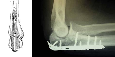 Elbow Olecranon Fractures OrthoInfo AAOS