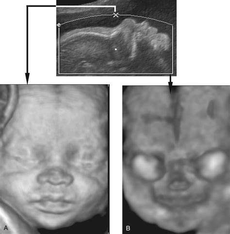 Ultrasound Evaluation Of The Fetal Face And Neck Radiology Key