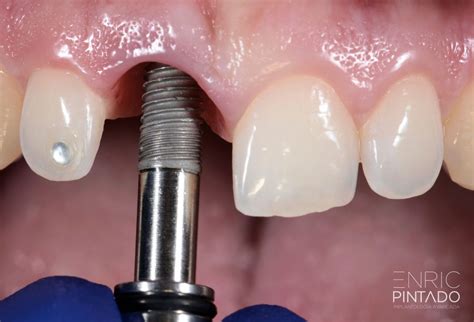Síntomas del rechazo en implantes dentales Enric Pintado