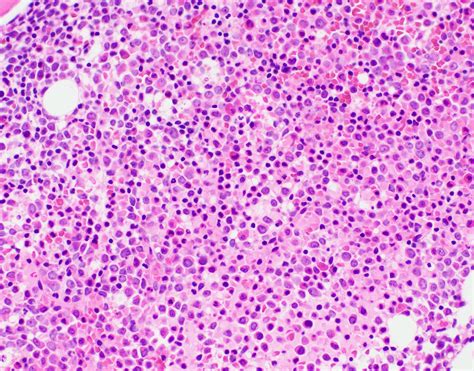 pathology outlines aml with t 8 21 q22 q22 runx1 runx1t1