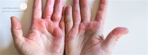 Neurodermitis an den Händen Symptome Pflege und Lösungen