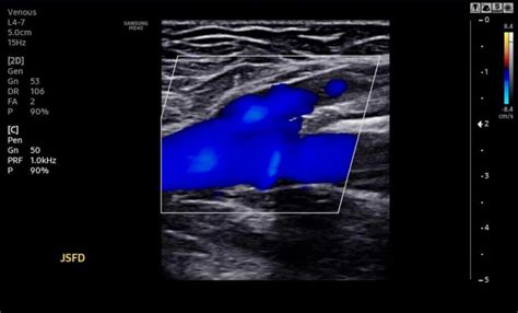 Ultrassom Doppler 1 Desvantagem Desse Exames