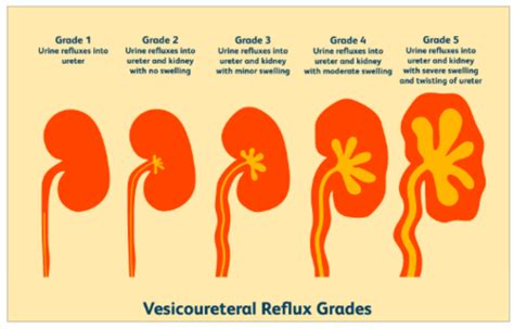 4 Peds GU Renal Flashcards Quizlet