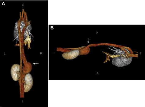 Three Dimensional CT Reconstruction Of The Interrupted CVC Coronal A