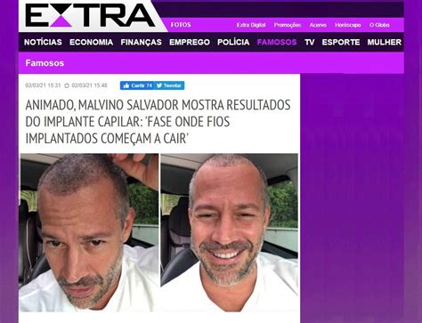 Animado Malvino Salvador Mostra Resultados Do Implante Capilar Fase