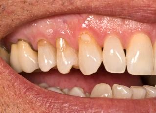 Treating Class V Lesions Spear Education