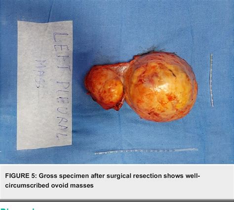 Figure 1 From A Rare Case Of Primary Pleural Neurofibroma Semantic