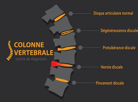 Hernie discale symptômes causes traitements et opération