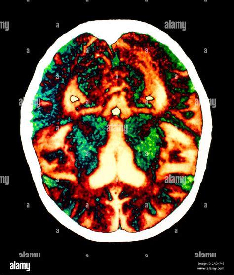 Alzheimer S Disease Coloured Computed Tomography CT Scan Of An Axial