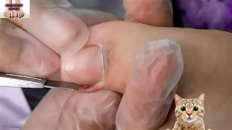 SUPER DEEP And HUGE INGROWN TOENAIL REMOVAL 1010 YouTube