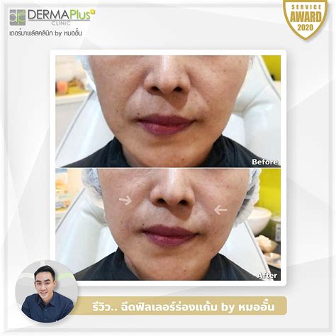 Fillers Dermaplus Clinic Phuket By
