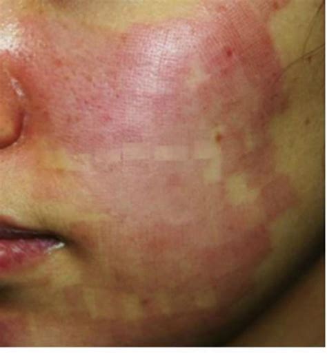 Láser Fraccionado CO2 Edge ONE Clínica Mediderma