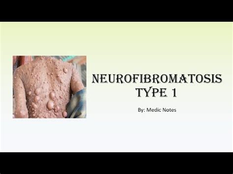 Neurofibromatosis Type 1 Definition Signs Diagnostic Criteria
