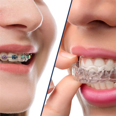 Qué es la ortodoncia invisible o invisalign Clínica Dental Implantes