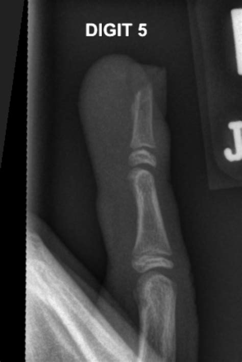 Distal Phalangeal Tuft Fracture With Osteolysis Radiology Case