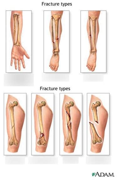 Fracture Types Diagram Quizlet