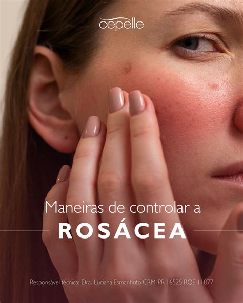 Maneiras de controlar a rosácea Cepelle Dermatologia Curitiba