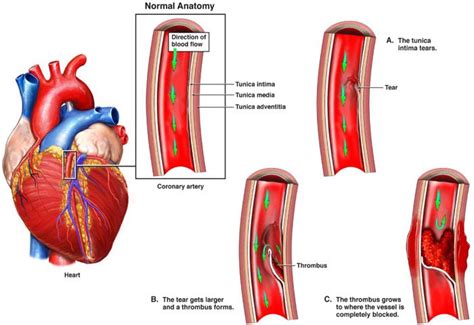 Spontaneous Coronary Artery Dissection Treatment
