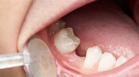 Agenesia Dental o Falta de Dientes Qué es y Causas
