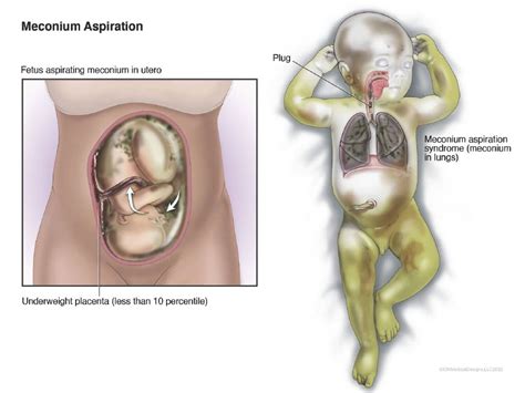Meconium Aspiration