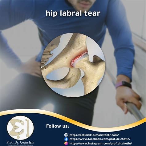 Hip Labrum Tear Causes And Treatment Methods Dr What S Wrong With You