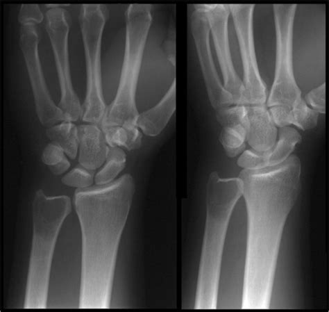 Msk Radiology Bone Disease Flashcards Quizlet