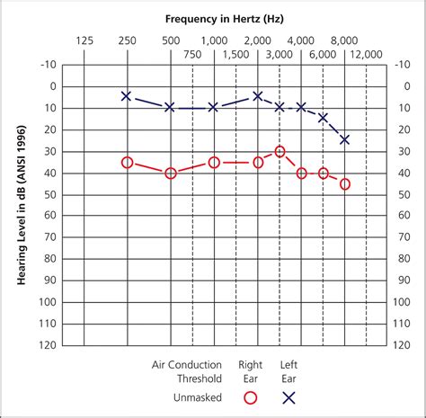 Hearing Loss And The Audiogram Explained