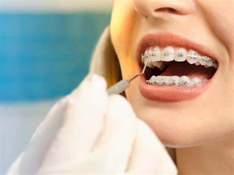 Dentes Tortos Chegou A Hora De Colocar Aparelho Nos Dentes
