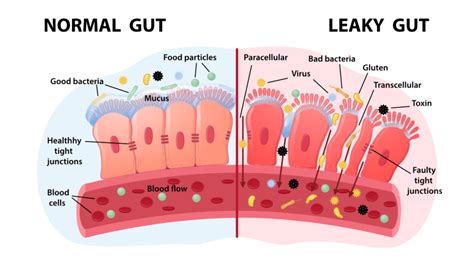 Leaky Gut BeGreen