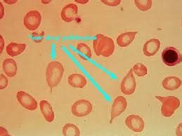 Hematology Clin Lab Flashcards Quizlet