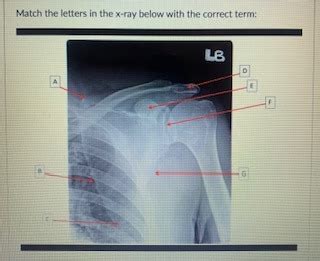 Practice Exam For Upper Extremity Flashcards Quizlet