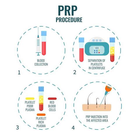 Knee Arthritis Pioneerining Treatment Platelet Rich Plasma Injections