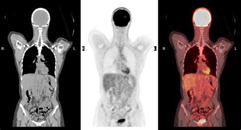 PET Scan Patient Education Brigham And Women S Hospital