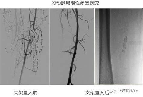 下肢动脉硬化闭塞症的介入治疗 医院动态 漳州正兴医院