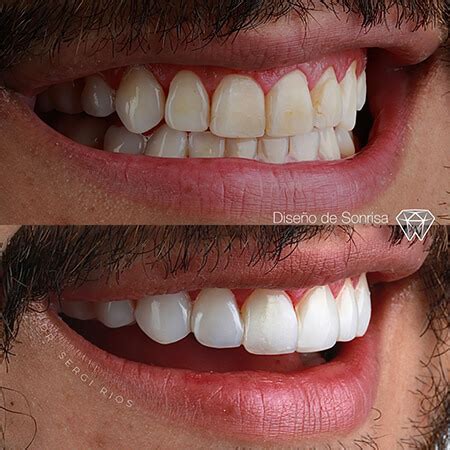 Antes y después diseño de sonrisa carillas dentales de Sergi Ríos