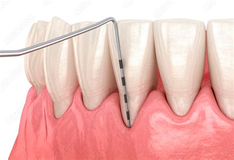 Encías retraídas Síntomas causas y tratamiento Clínica dental