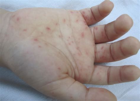 Cách chăm sóc và điều trị hình ảnh bệnh chân tay miệng ở trẻ nhỏ hiệu quả
