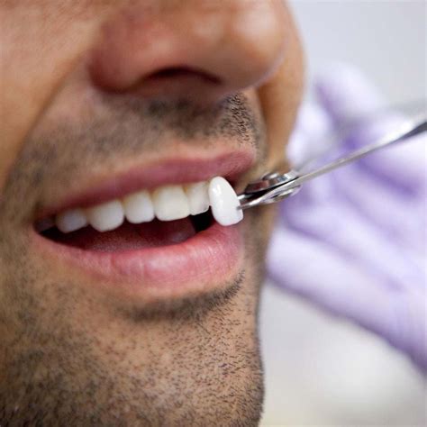 BEST Dental Veneers For Your Smile Regent Dental Practice Cambridge